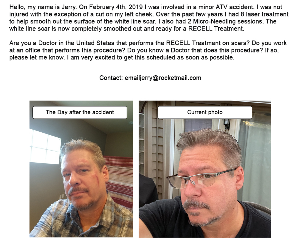 RECELL Autologous Cell Harvesting